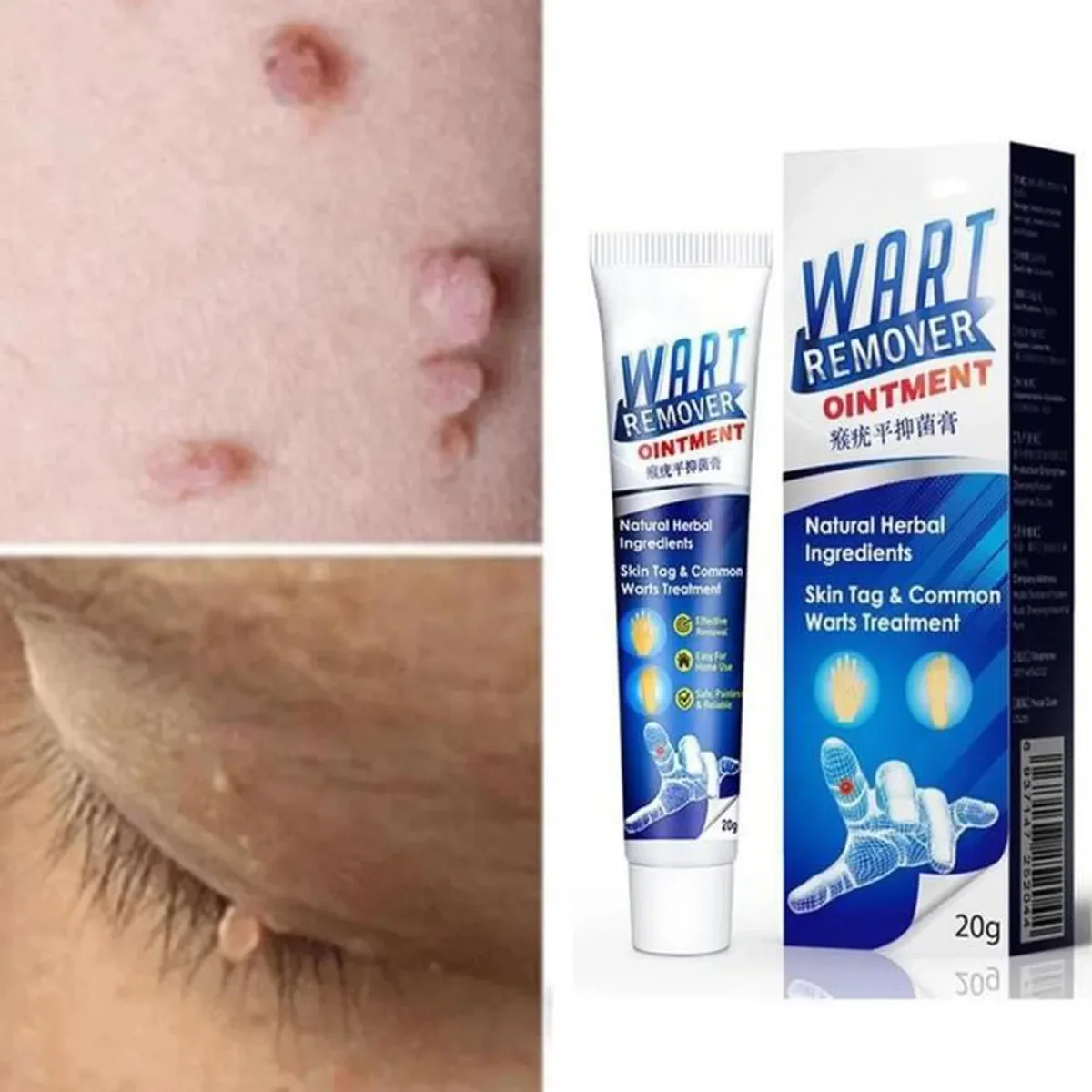 Pommade contre les verrues et les grains de beauté. – kinshashop