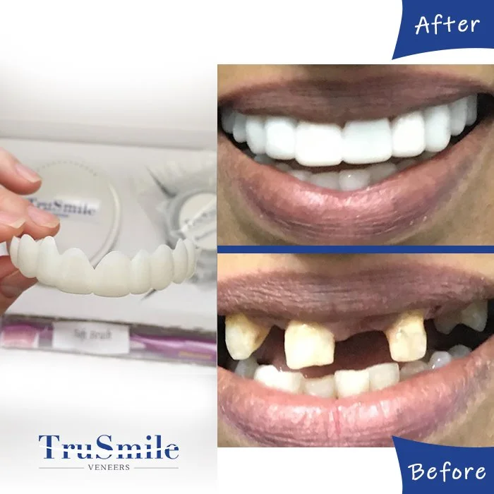 Prothèse-dentaire-flexible